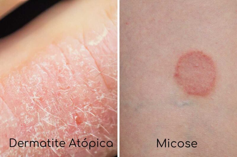 Dermatite Atópica: O que é, sintomas, causas e tratamento | CliniGuia