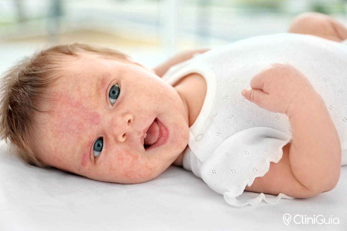 Brotoeja em bebê: como cuidar delas e como tratar? | CliniGuia
